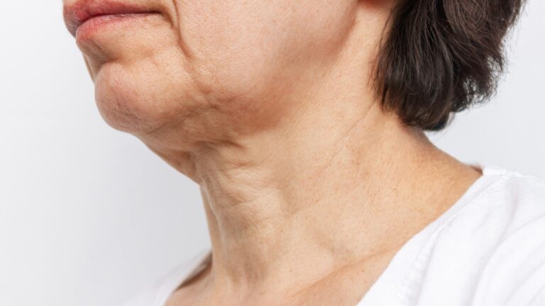 SKIN LAXITY – Rejuvenate MD